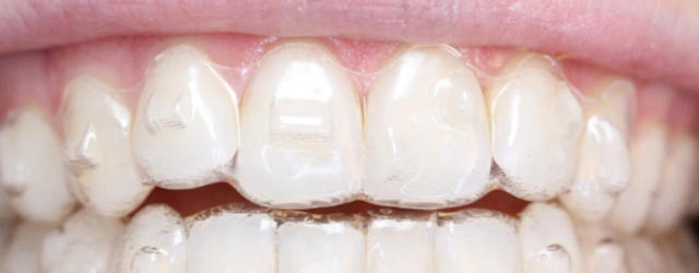 Ataches Invisalign: qué son, para qué sirven y cómo se colocan